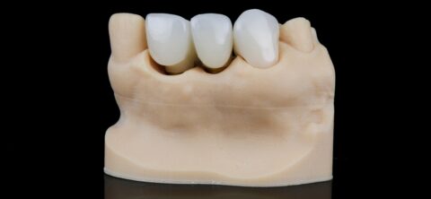 Dental Crowns Before and After: A Comprehensive Guide