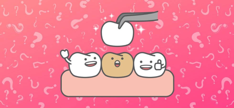 What Is A Dental Crown: A Clear Guide on Fixing Your Teeth