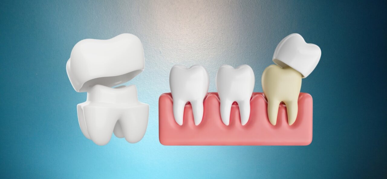What Is A Dental Crown: A Clear Guide on Fixing Your Teeth