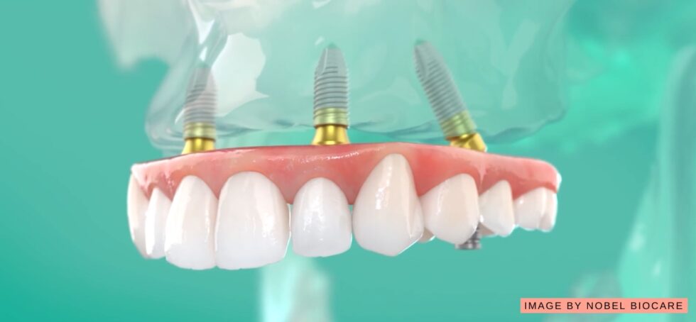 How to Floss All on 4 Dental Implants: Easy to Follow Guide