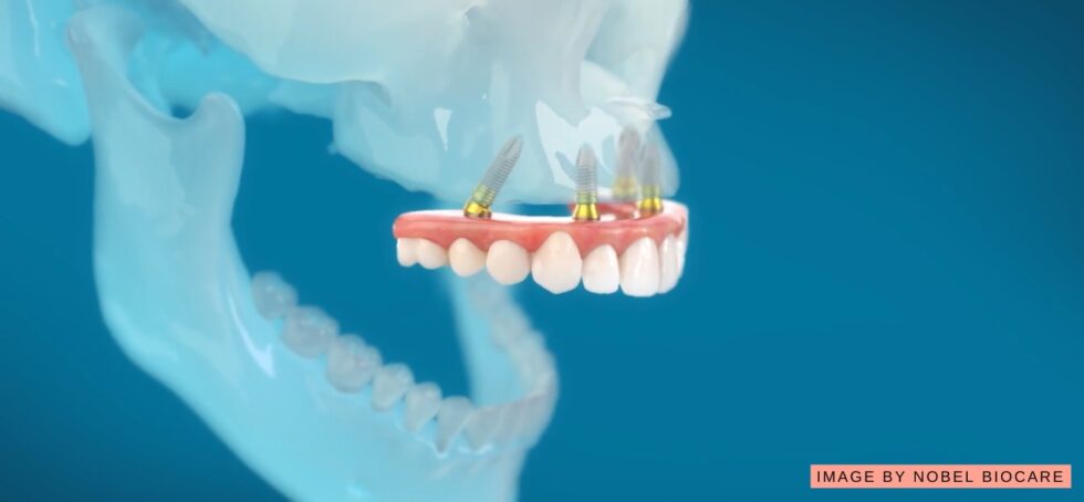 How to Floss All on 4 Dental Implants: Easy to Follow Guide